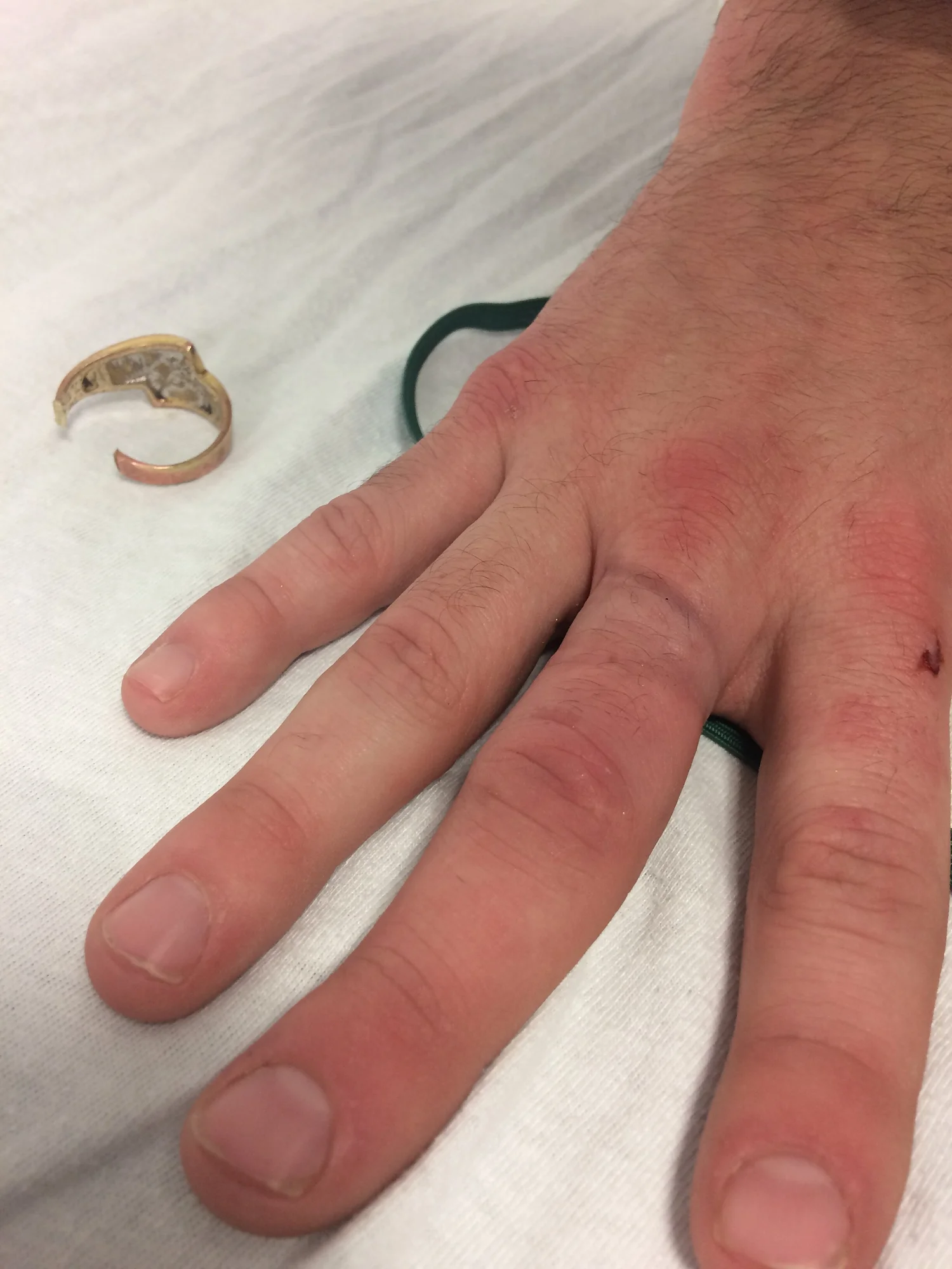 Can You Remove Every Stuck Ring Without Cutting? — Ring Rescue - Stuck ...