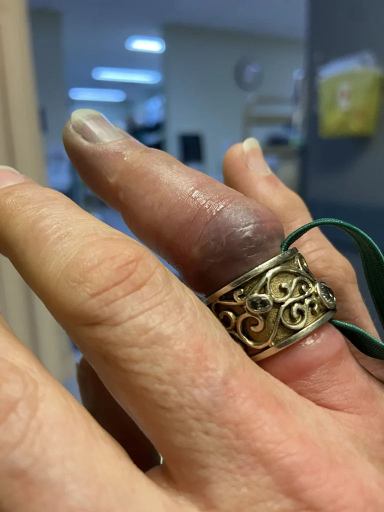 The Use Of A Ring Block To Aid In Difficult Stuck Ring Removal Case ...